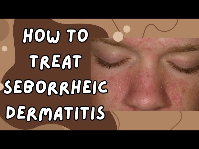 Seborrheic Dermatitis