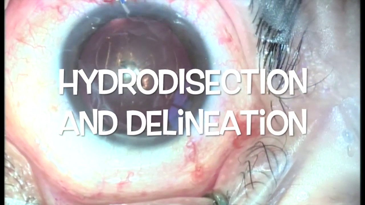 Phaco in Soft Cataract (Tilt and Tumble) Dr KOZAR TAWFIQUE - YouTube