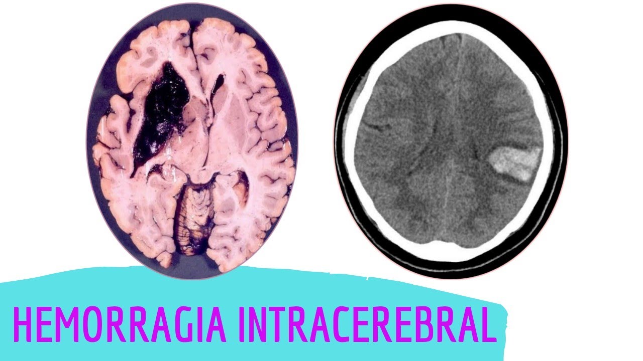 Impressionante hemorragia Intracerebral | Medicina Geral - YouTube