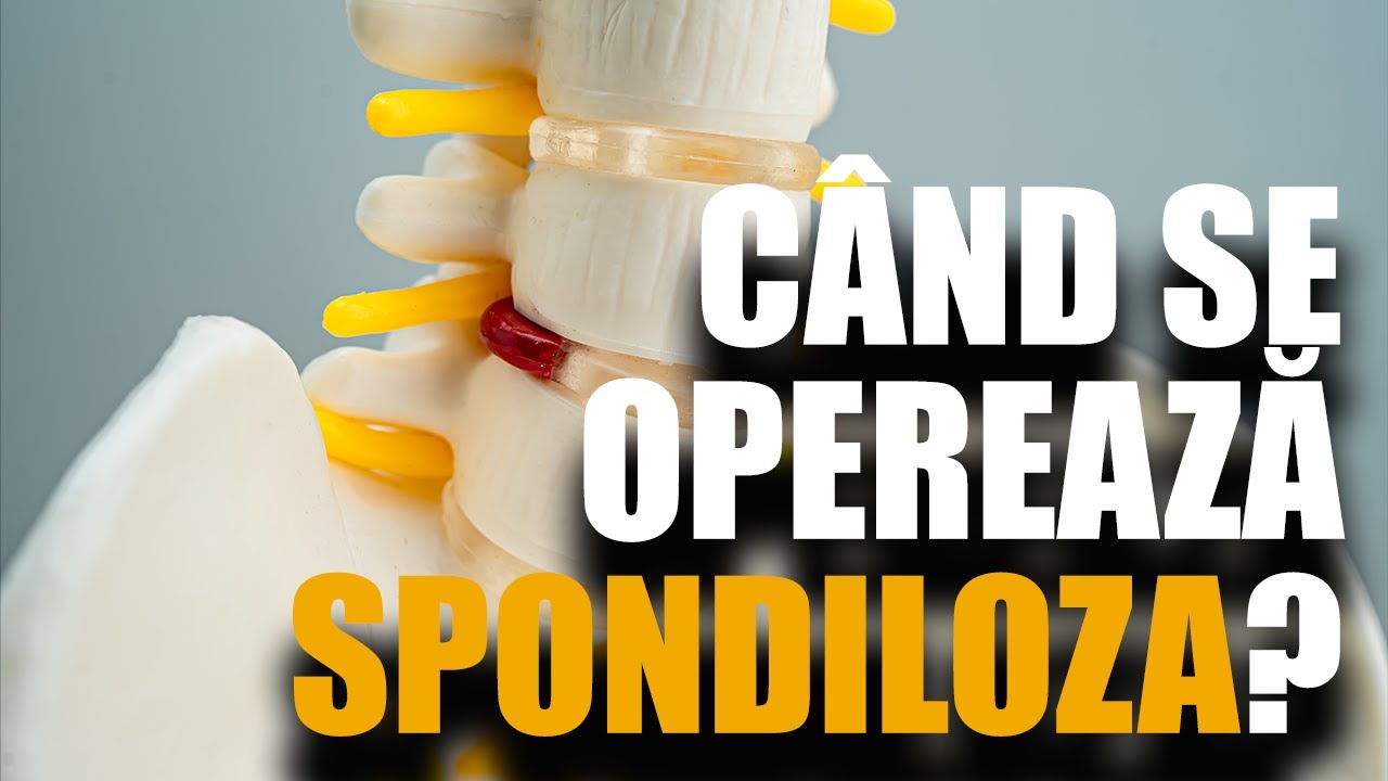 Spondiloza: când se operează? - YouTube