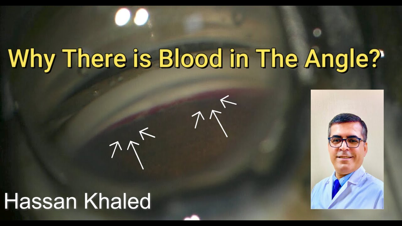 Why There is Blood in The Angle? - YouTube