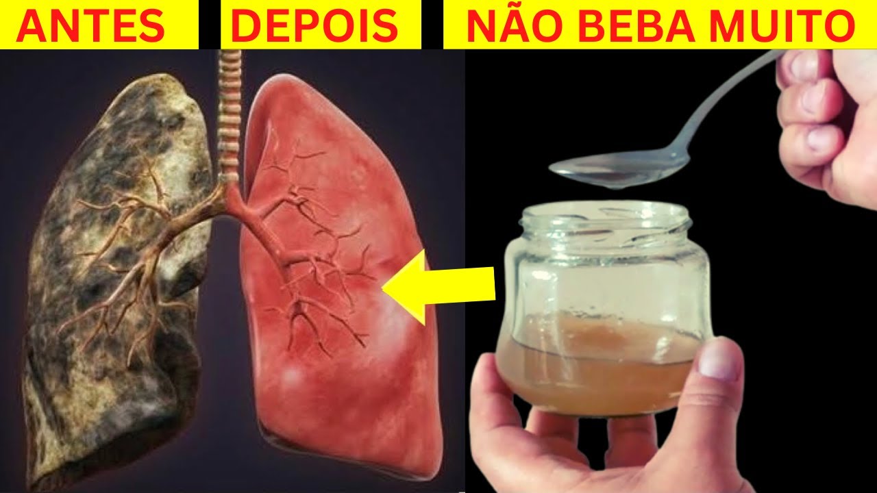 ISSO Acaba Com a TOSSE, LIMPA O PULMÃO, Elimina O CATARRO, Combate a ...