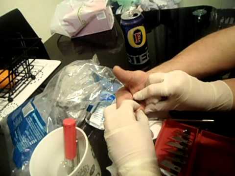 cutting out a cyst...Home surgery!! #cyst - YouTube