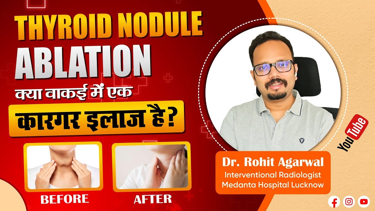 Thyroid Nodule Symptoms and Treatment | Thyroid Nodule Ablation | Dr. Rohit Agarwal Medanta ...