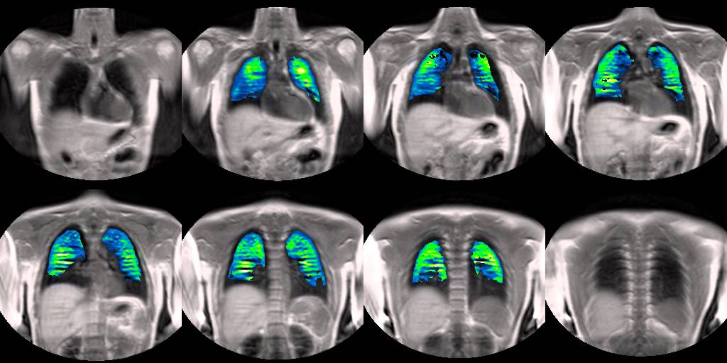 Bioxydyn - Whole lungs 3D dynamic oxygen-enhanced MRI - YouTube