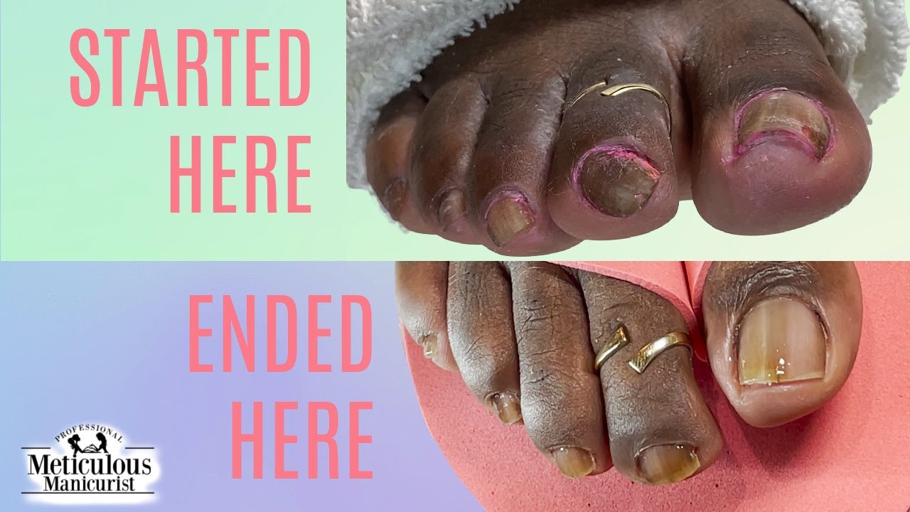 👣Rams Horn Big Toenail Where she started and where she is now👣 - YouTube