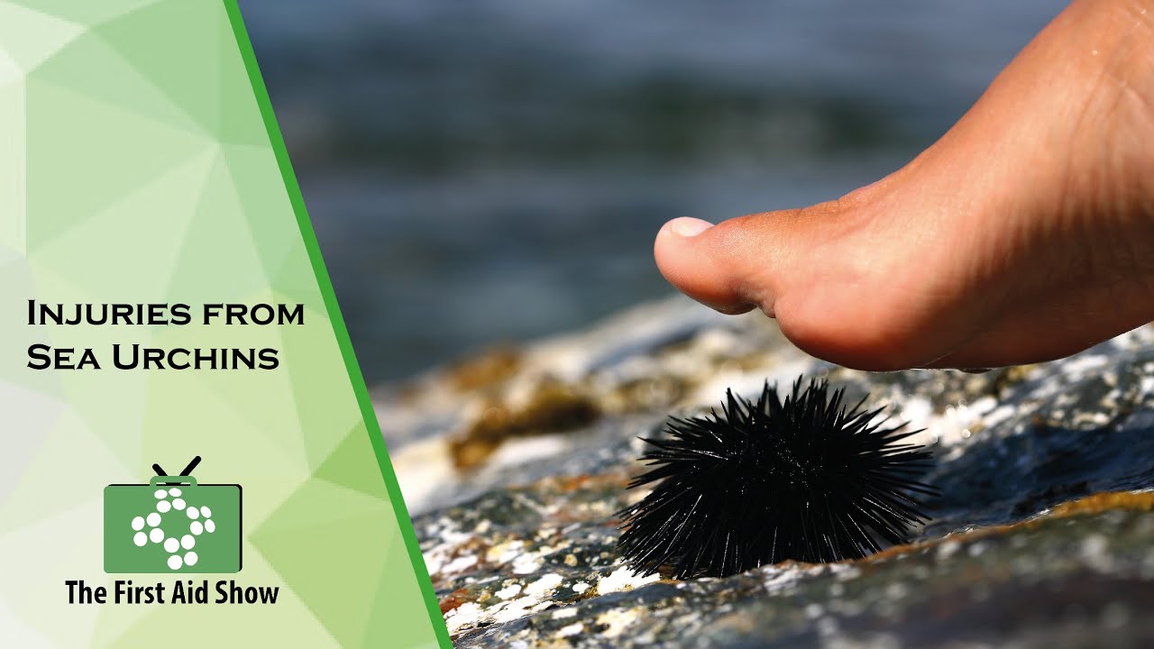 Sea Urchin Spines In Foot