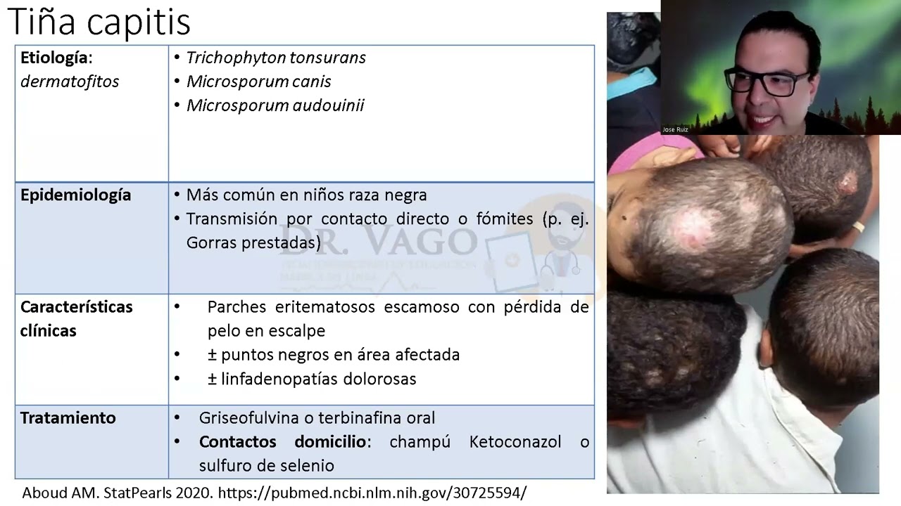Tiña Capitis #ENARM - YouTube