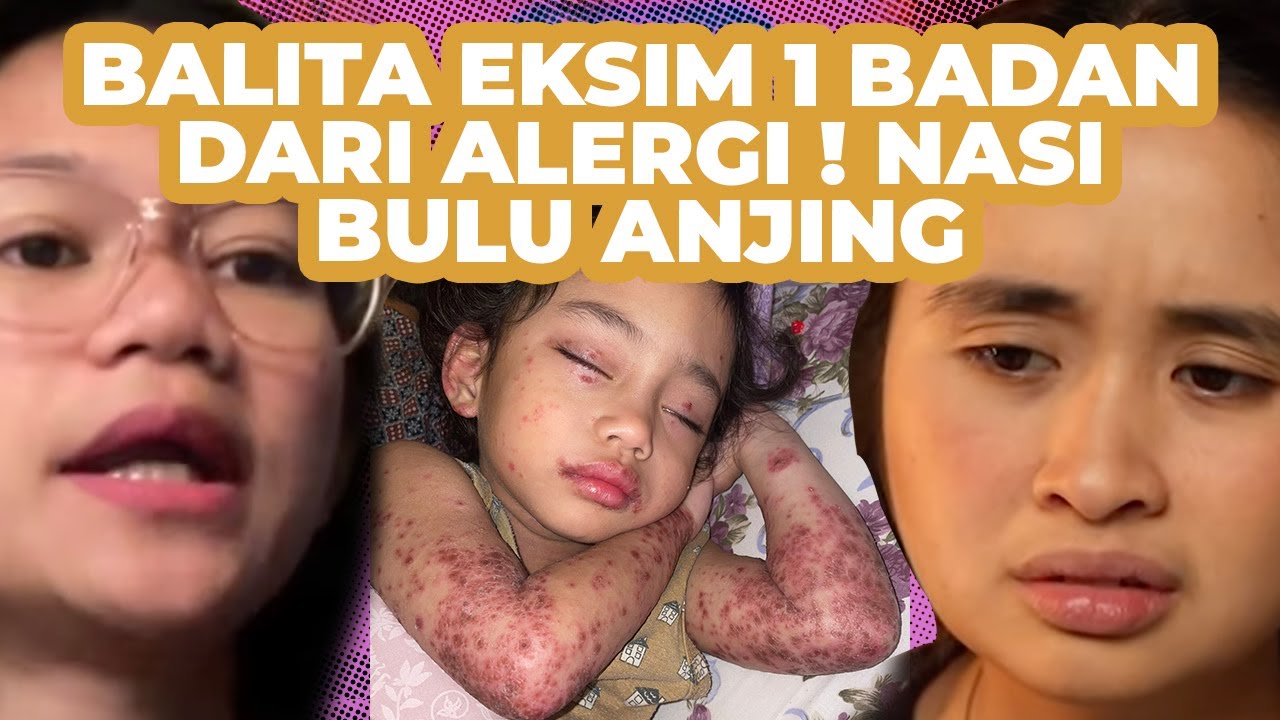 HATI2 NGIRA KENA FLU SINGAPURA TERNYATA EKSIMA | #GritteBukaPraktek ...