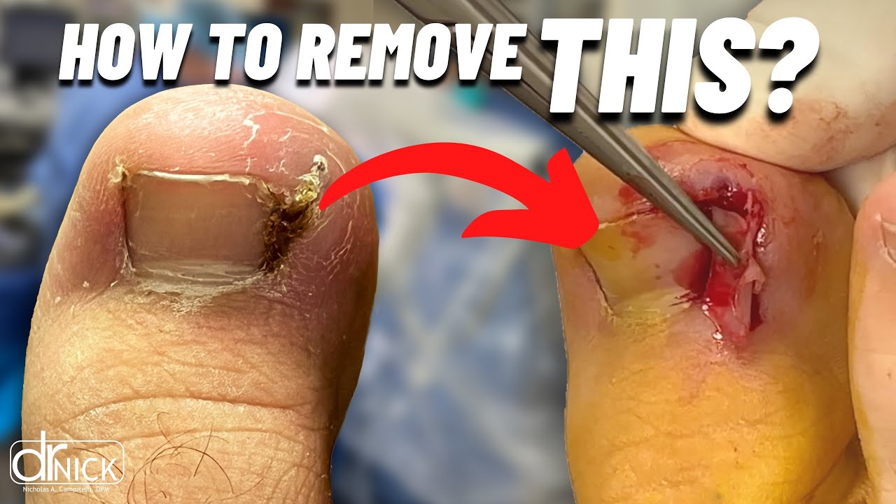 INGROWN TOENAIL WITH SPIKE GROWING INTO TOE!😱 | Dr. Nick Campitelli ...