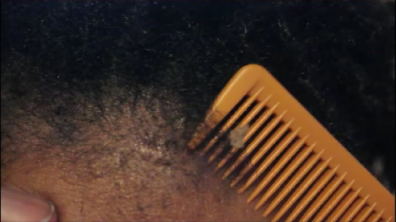 DANDRUFF PATCHES ON CLEAN SCALP - YouTube