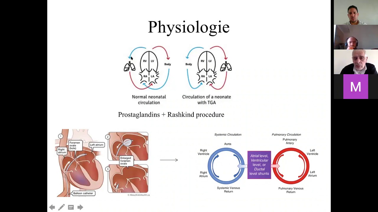 chirurgie de la transposition des gros vaisseaux : part 1 - YouTube