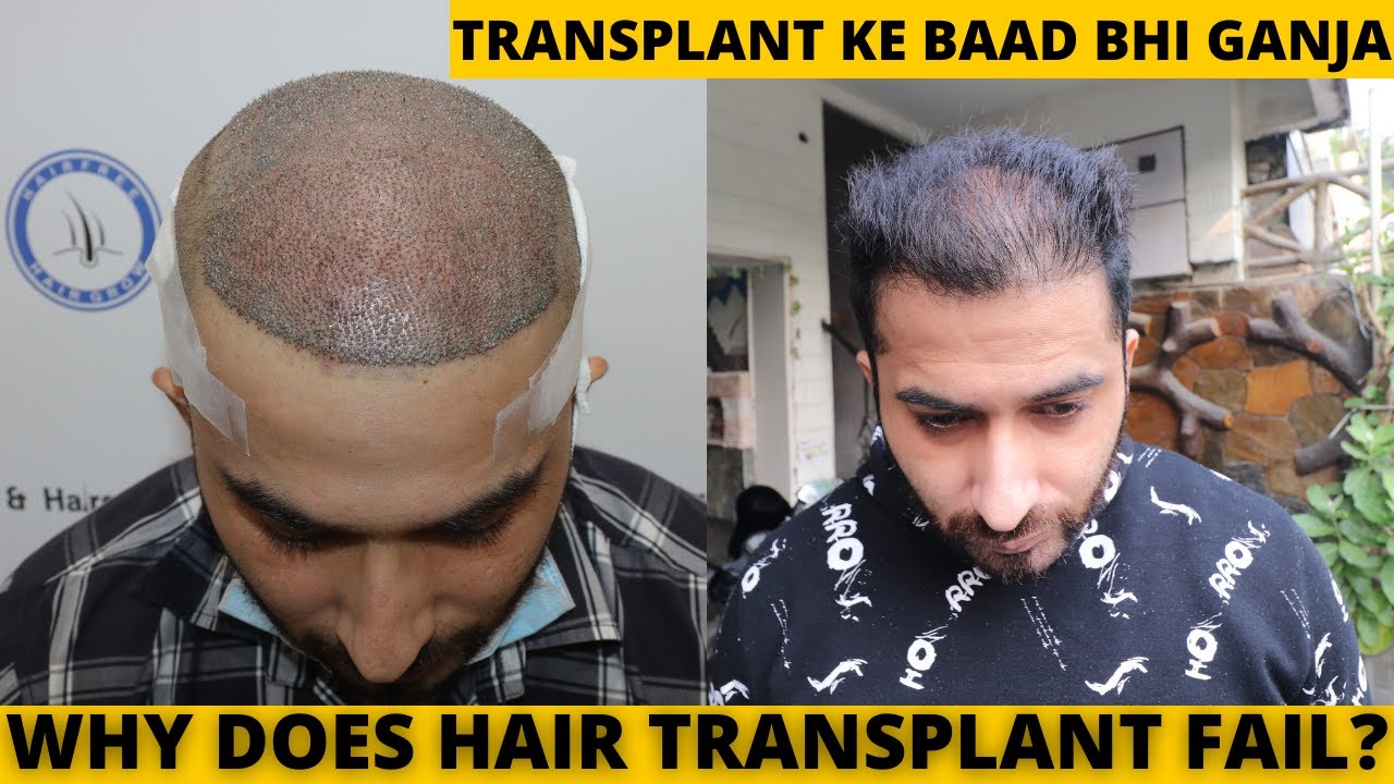 Why does Hair transplant fail | Hair transplant result | Born Creator ...