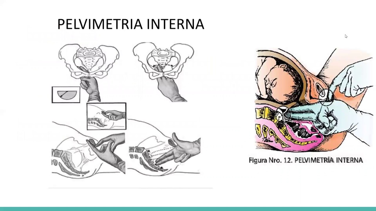 Distocia 16/4 - YouTube