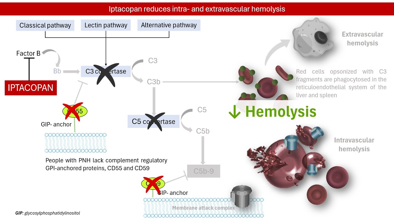 The Science Behind Iptacopan: How It Works in Paroxysmal Nocturnal ...