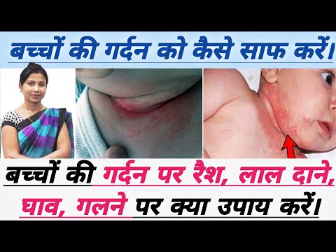 बच्चों की गर्दन पर रैश, Neck Rash घाव या गलने पर क्या करे।  how to clean baby neck rash.