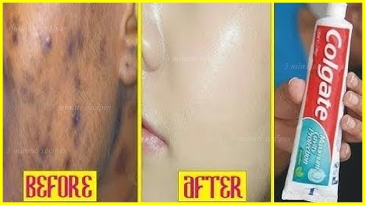 In 2 DAYS-Remove DARK SPOTS With Toothpaste Apply Toothpaste on Your ...