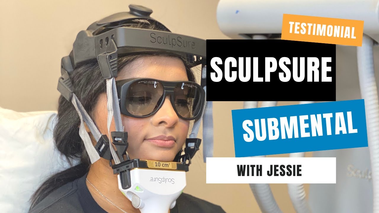 Sculpsure Submental Double Chin Results | San Antonio, TX | Sculpt Away ...