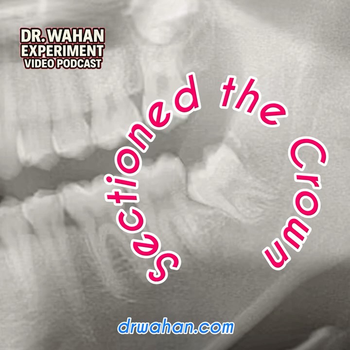 Horizontal Crown Sectioning for Wisdom Tooth - YouTube