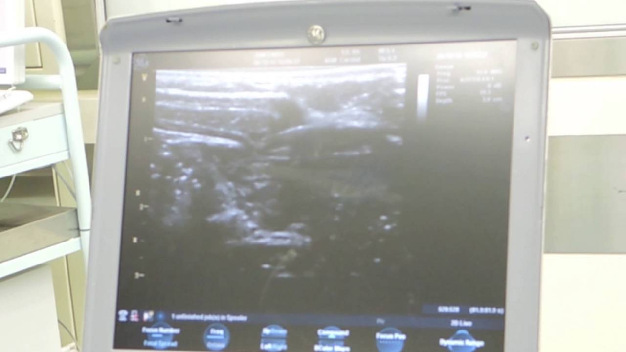 pediatric TAP Block with 25G blunt needle - YouTube