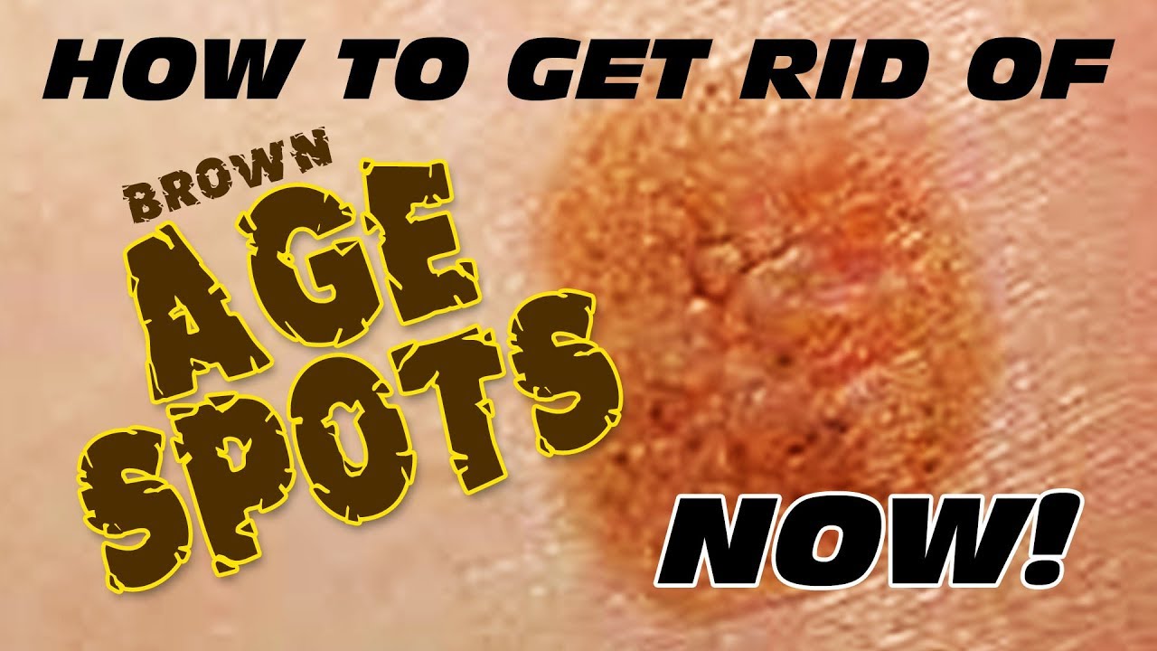 How To Get Rid Of Brown Age Spots YouTube how-to-get-rid-of-brown-age-spots-youtube