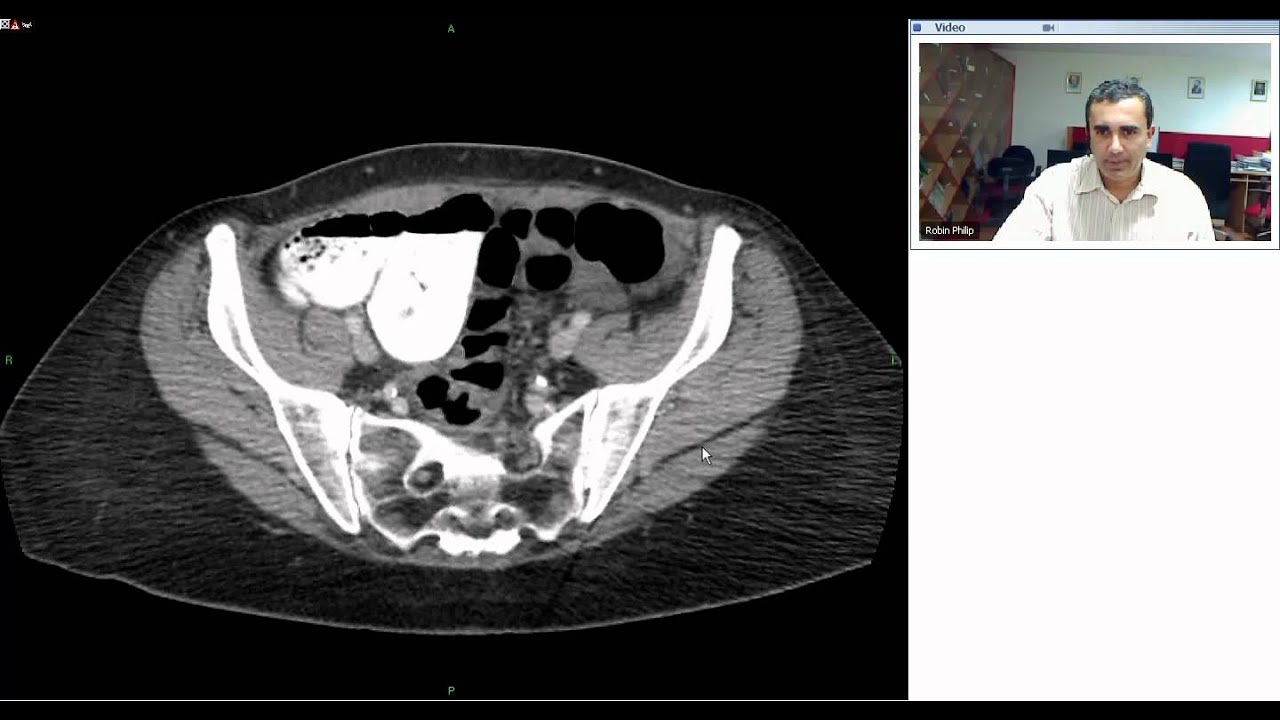 Radiology - Splenic rupture following colonoscopy by Dr Arjun Kalyanpur ...