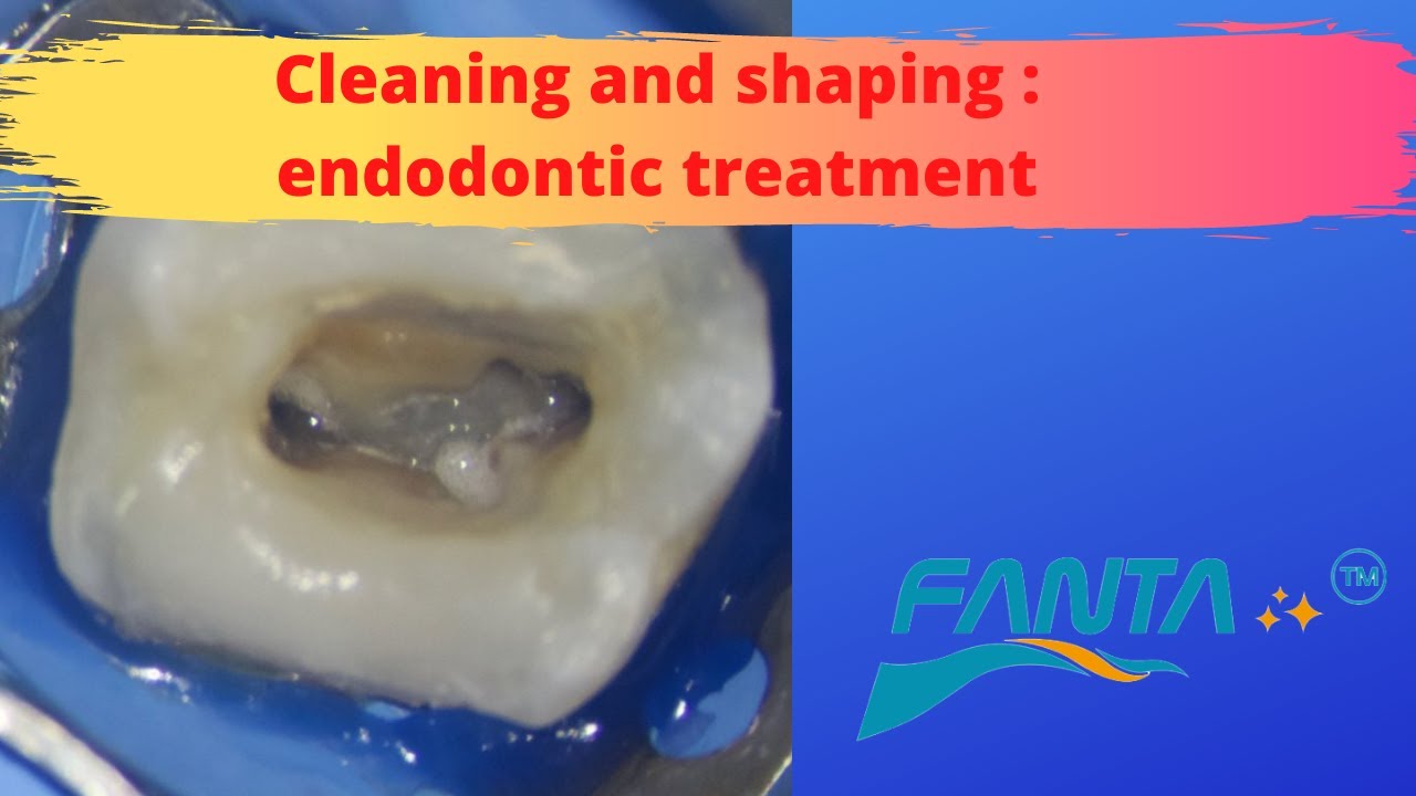 Cleaning and shaping using Fanta F One Blue rotary files - YouTube