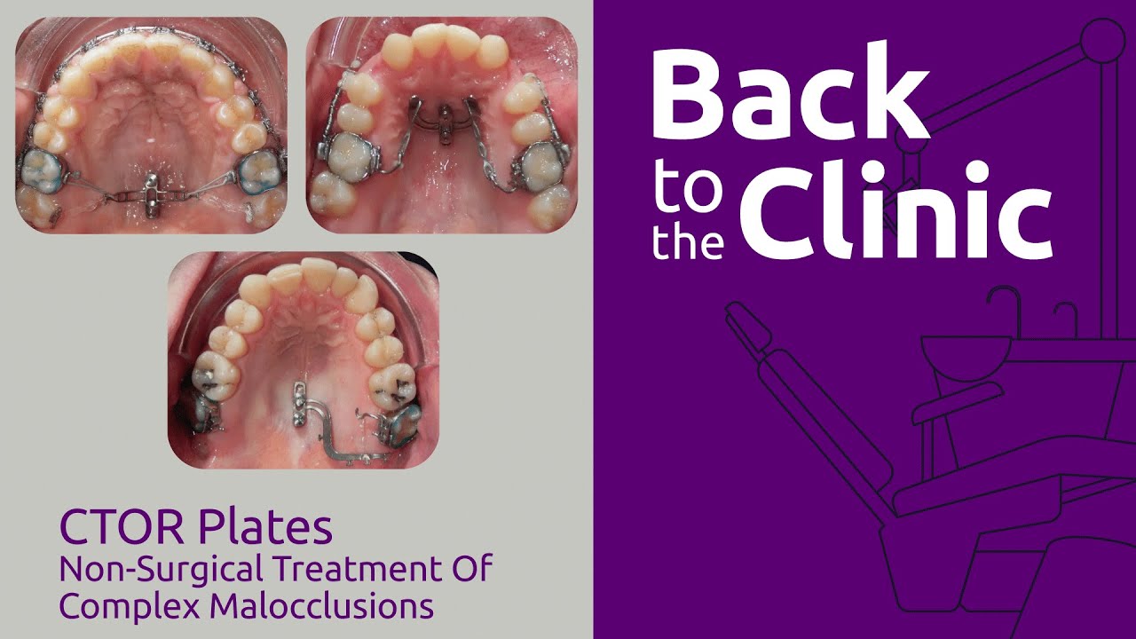 CTOR Plates: Non-surgical Treatment of Complex Malocclusions - Back to ...