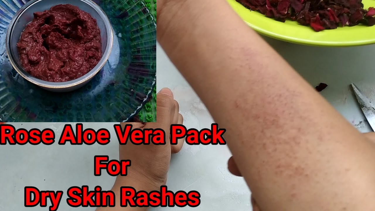 Home Remedy Rose - Aloe Vera Pack For Dry Skin Rashes - YouTube