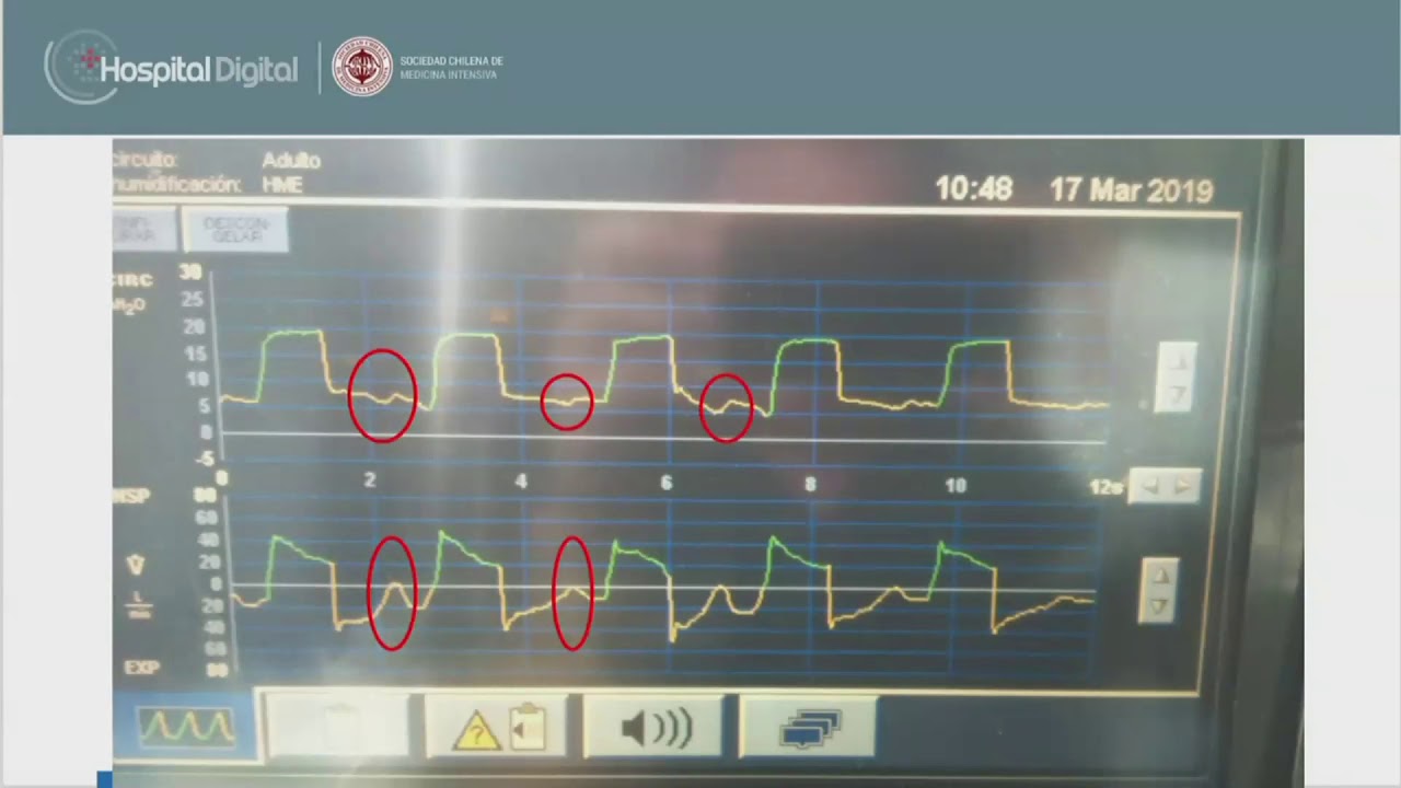 Asincronía del Paciente en VMI - YouTube