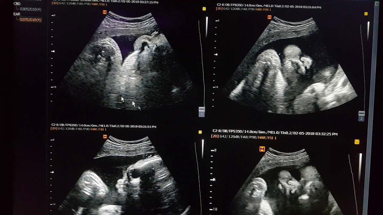 Fetal Ear Nose Lip eye Sonography - YouTube