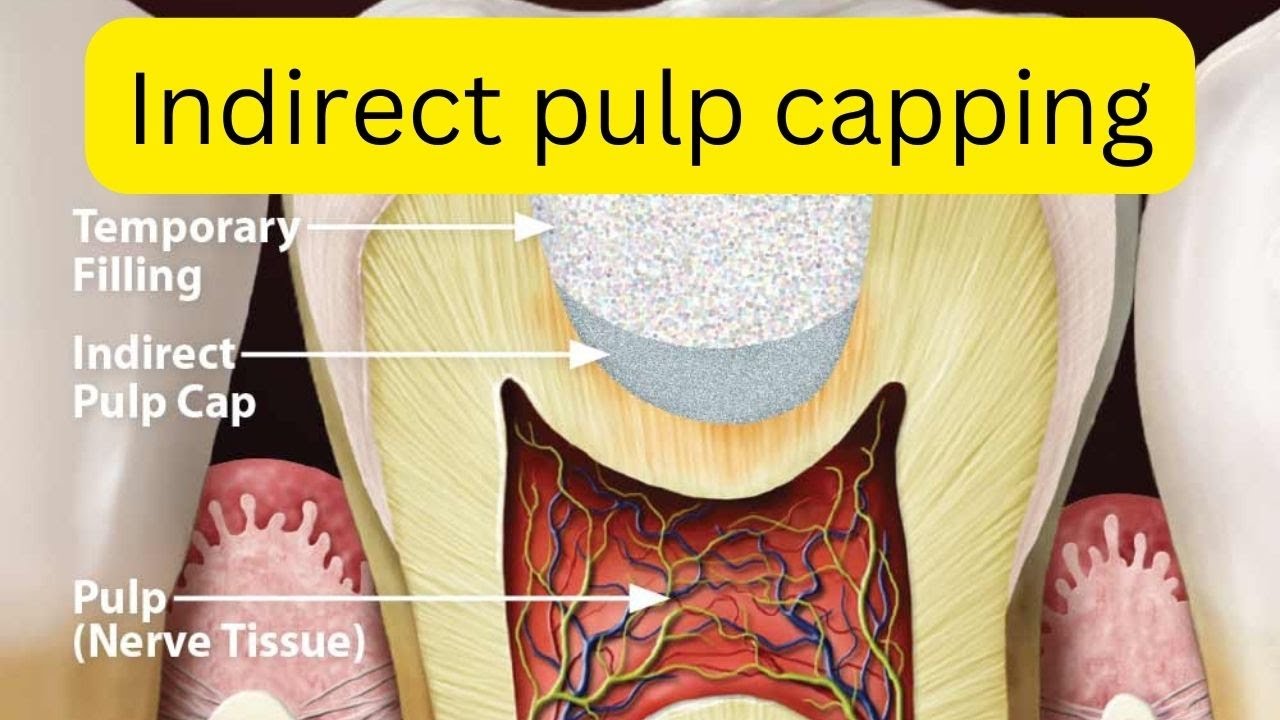 Indirect pulp capping steps (SIMPLIFIED) - YouTube