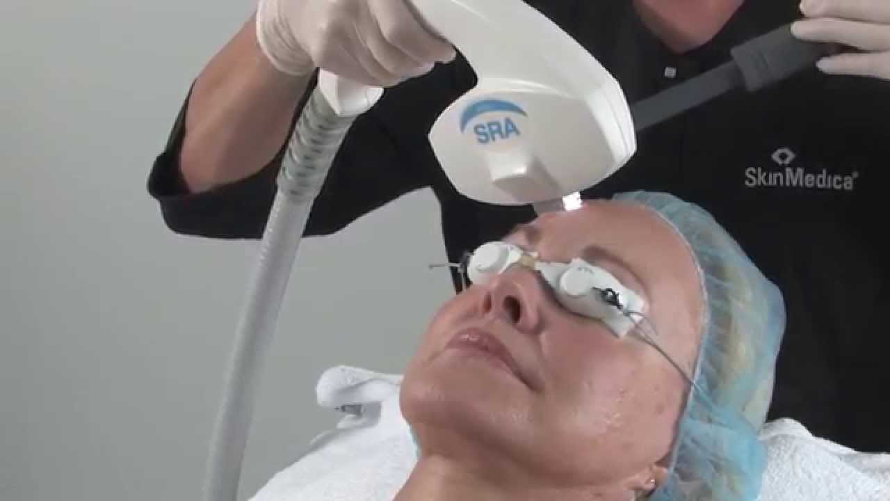 Eliminate Brown Spots and Photo-damage with Fotofacial™ RF - YouTube
