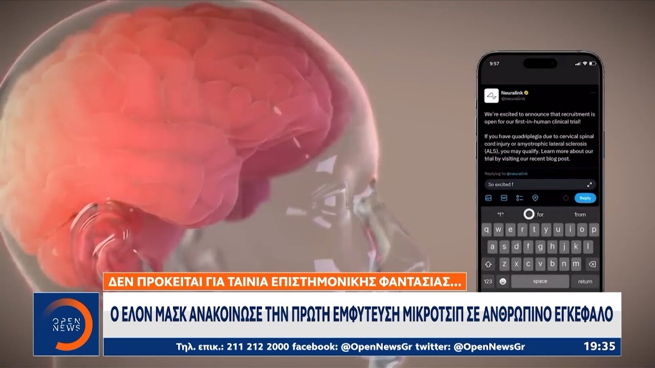 «Τηλεπάθεια»: Ο Ελον Μάσκ ανακοίνωσσε την πρώτη εμφύτευση μικροτσίπ σε ...