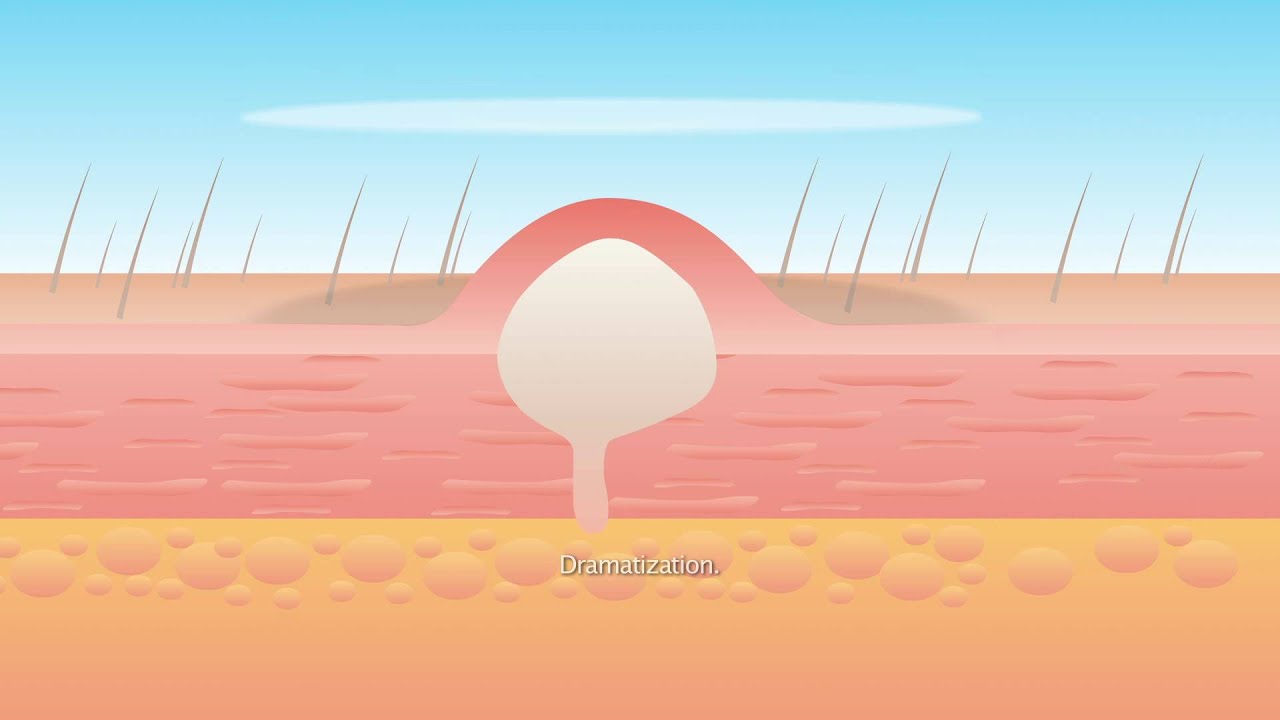 Acne Dots Official Commercial - YouTube