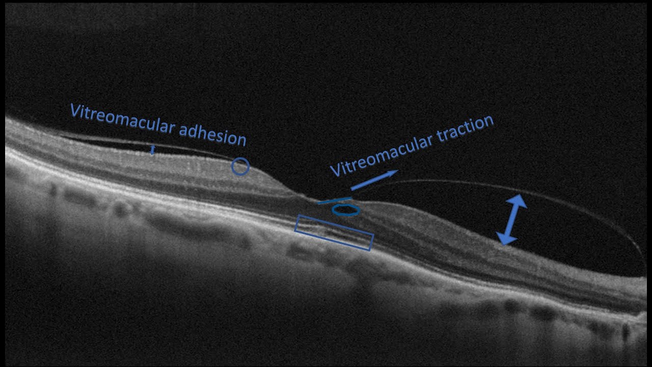 Course in clinical applications of OCT for macular diseases ...