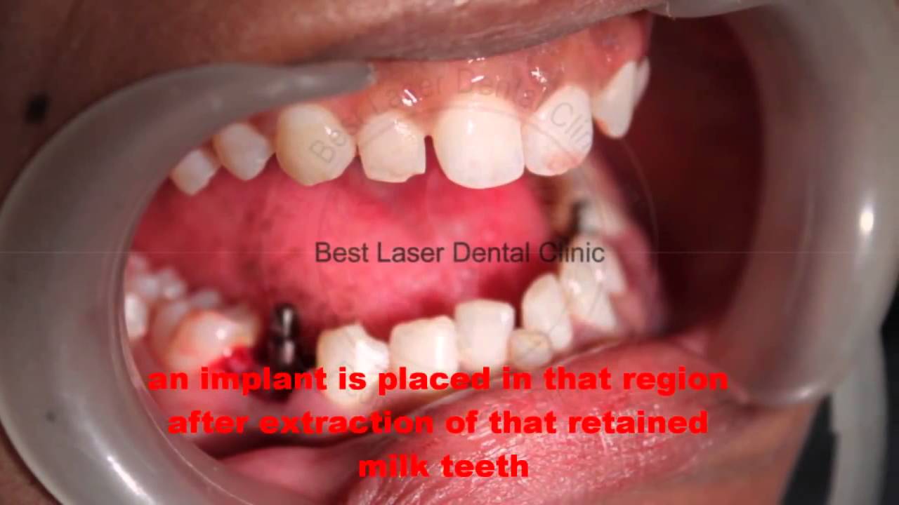 Rretained milk tooth extraction and immediate implant placement in ...