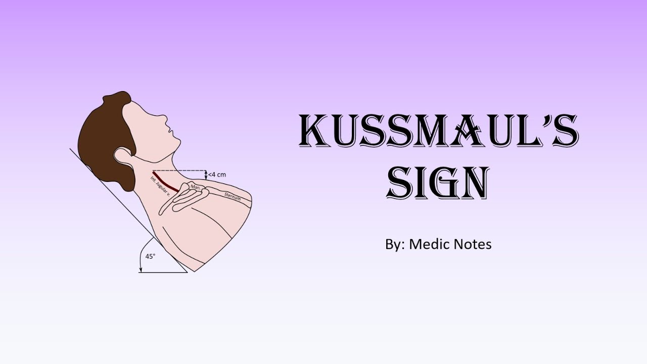 Kussmaul's sign - definition, causes, pathophysiology, sign value - YouTube