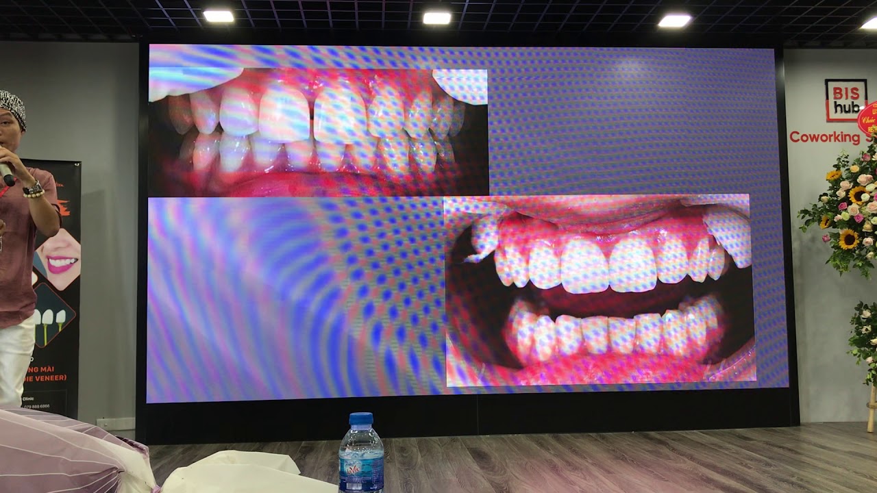 REFRACTORY DIE VENEER 2 - YouTube