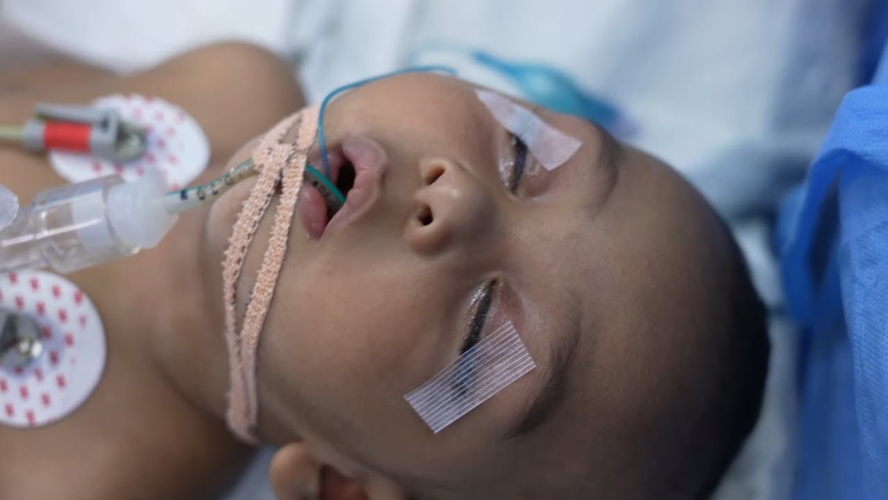 Palate Baby going under Deep Sleep - General Anesthesia - YouTube