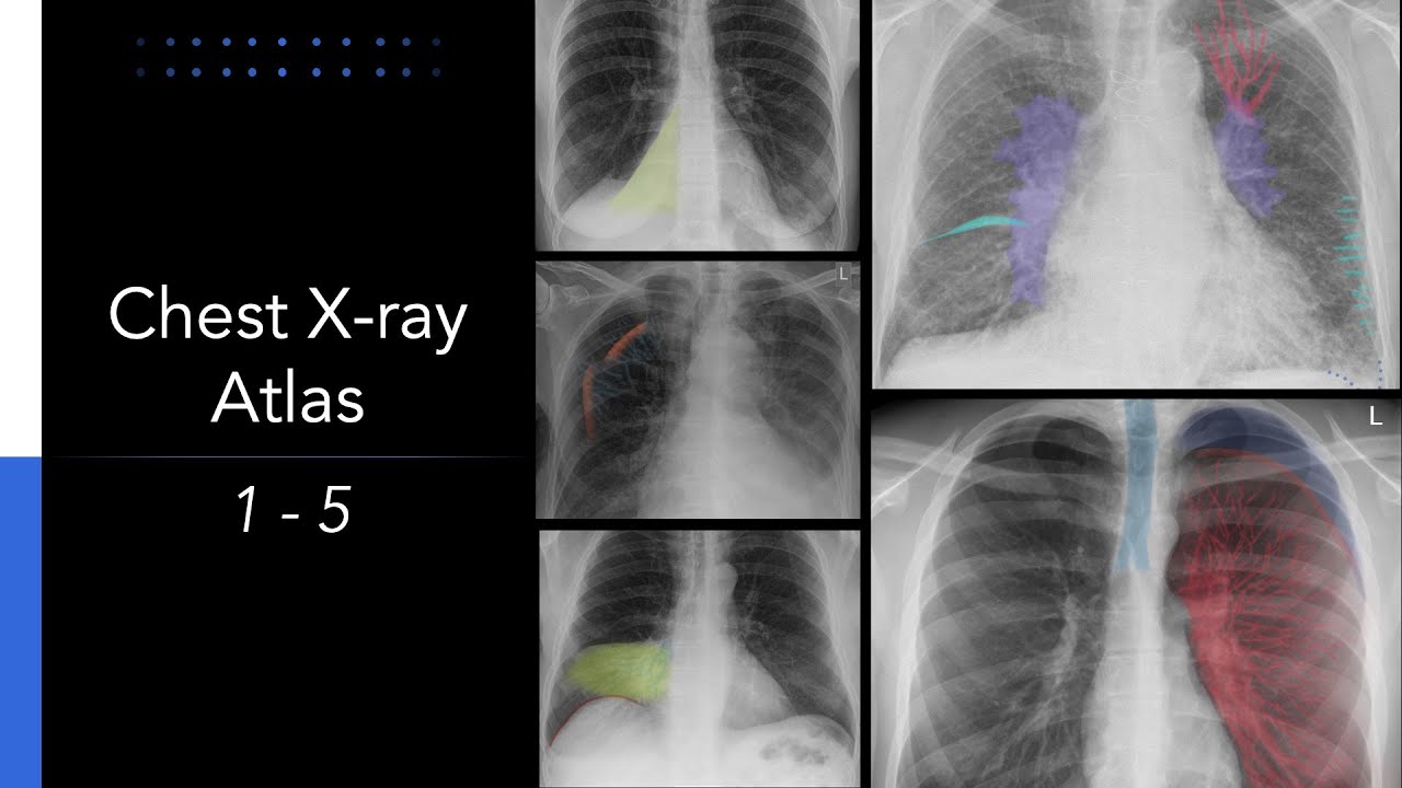 Chest X-ray Atlas: 5 Essential Chest X-rays for Students - YouTube