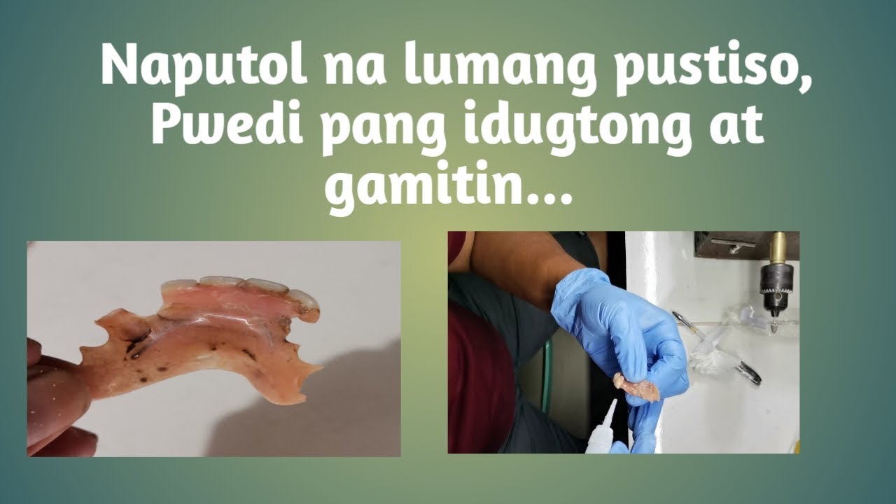 Naputol na lumang pustiso, pwedi pang ayusin at magamit - YouTube