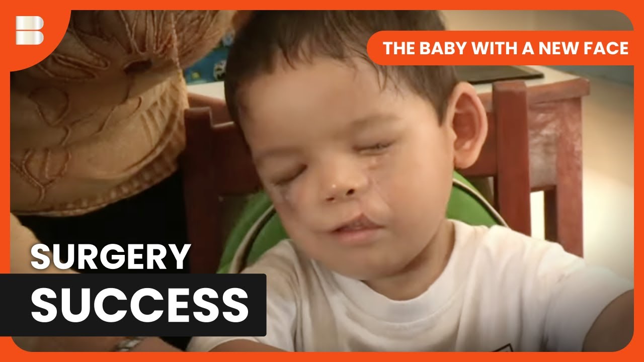 Cleft Face Why The Long Face? New Study Uncovers Genes Regulating Your