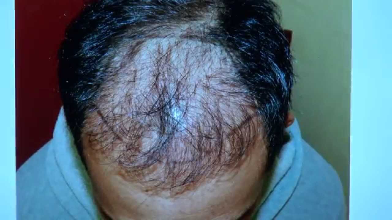 FUE Hair Transplant Follicular Unit Extraction Method Result Before ...