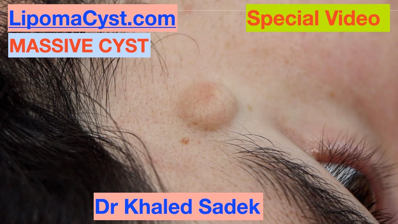 Awkward Face Cyst. Dr Khaled Sadek LipomaCyst.com - YouTube