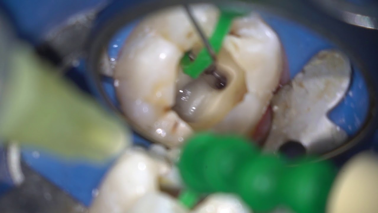 Mesial root canals and isthmus disinfection - YouTube