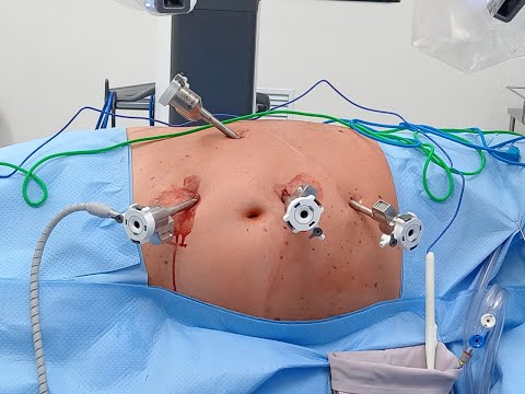 NEFRECTOMÍA PARCIAL ROBOT ASISTIDA DE RESCATE. NEFRECTOMIA PARCIAL POST ...