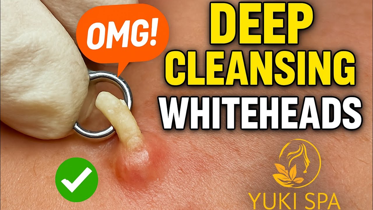 Relaxing Acne Extraction | Deep Pore Cleansing Facial | Yuki Spa - YouTube