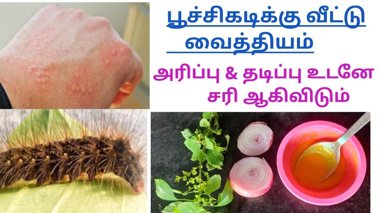 விஷ பூச்சி,கம்பளி பூச்சி, தேள் கடித்து உடம்பு முழுவதும் வீங்கி உள்ளதா ...