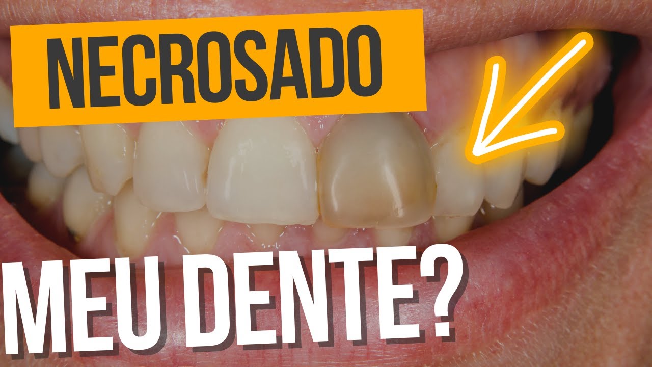 Dente Necrosado | O que é um dente necrosado e como tratar ? - YouTube